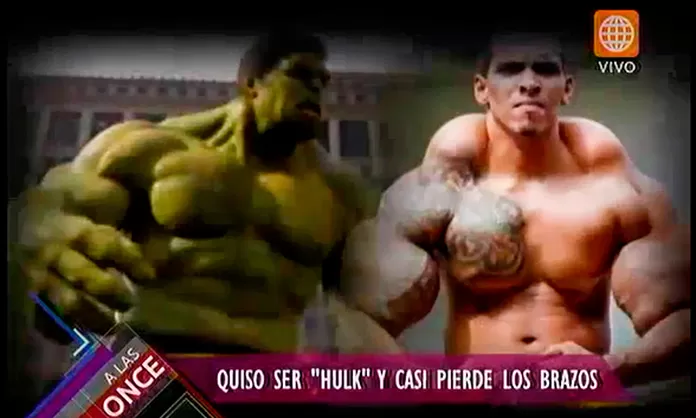 La increíble historia del "Hulk" brasileño que casi pierde los brazos